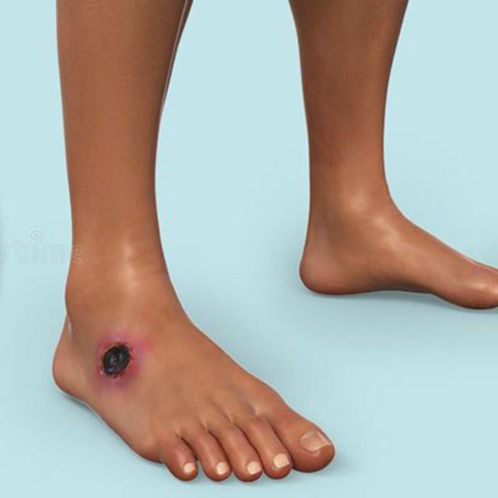 Nhận biết dấu hiệu bệnh than