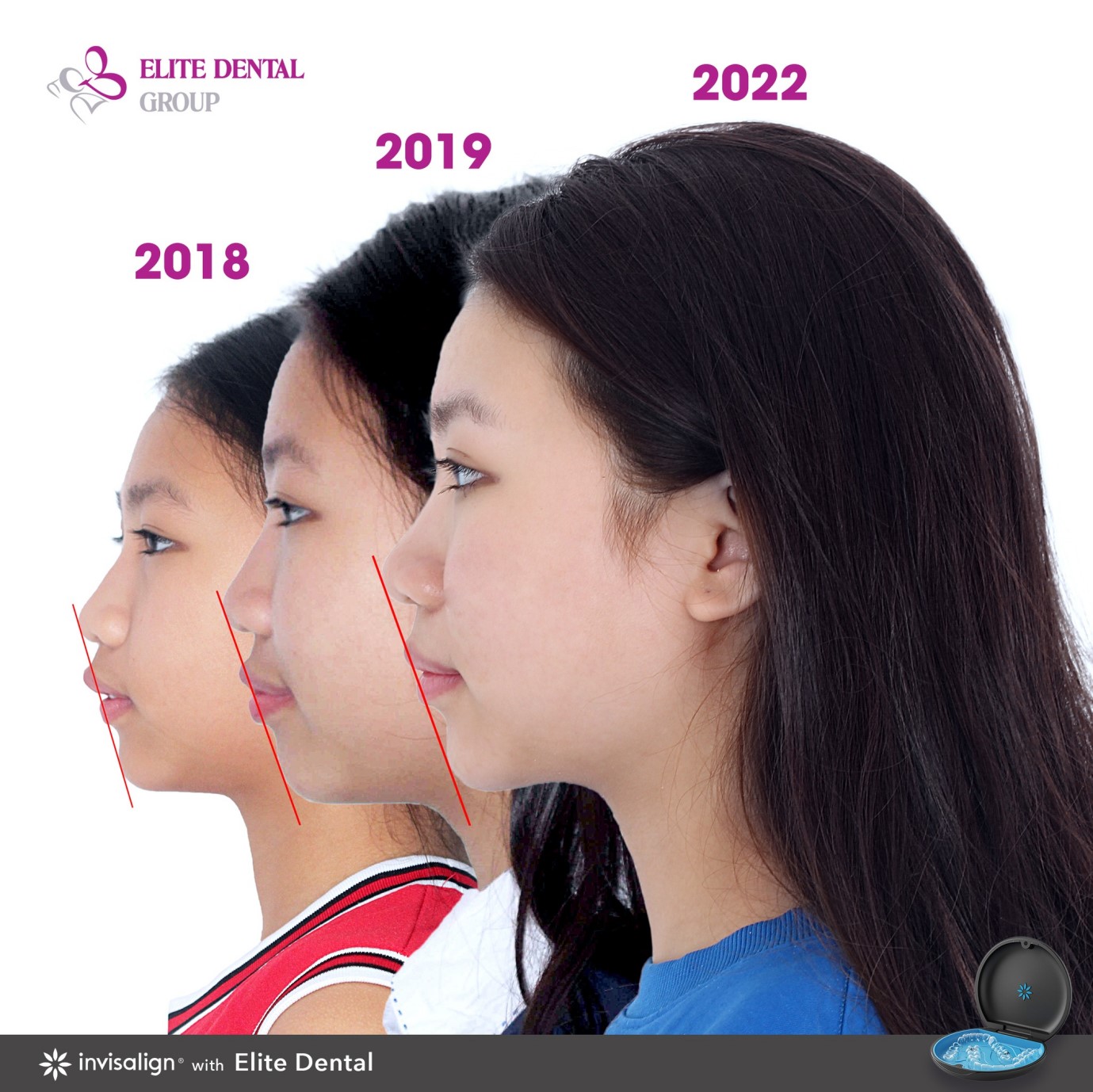 Niềng răng trong suốt có đau không, giai đoạn nào đau nhất?