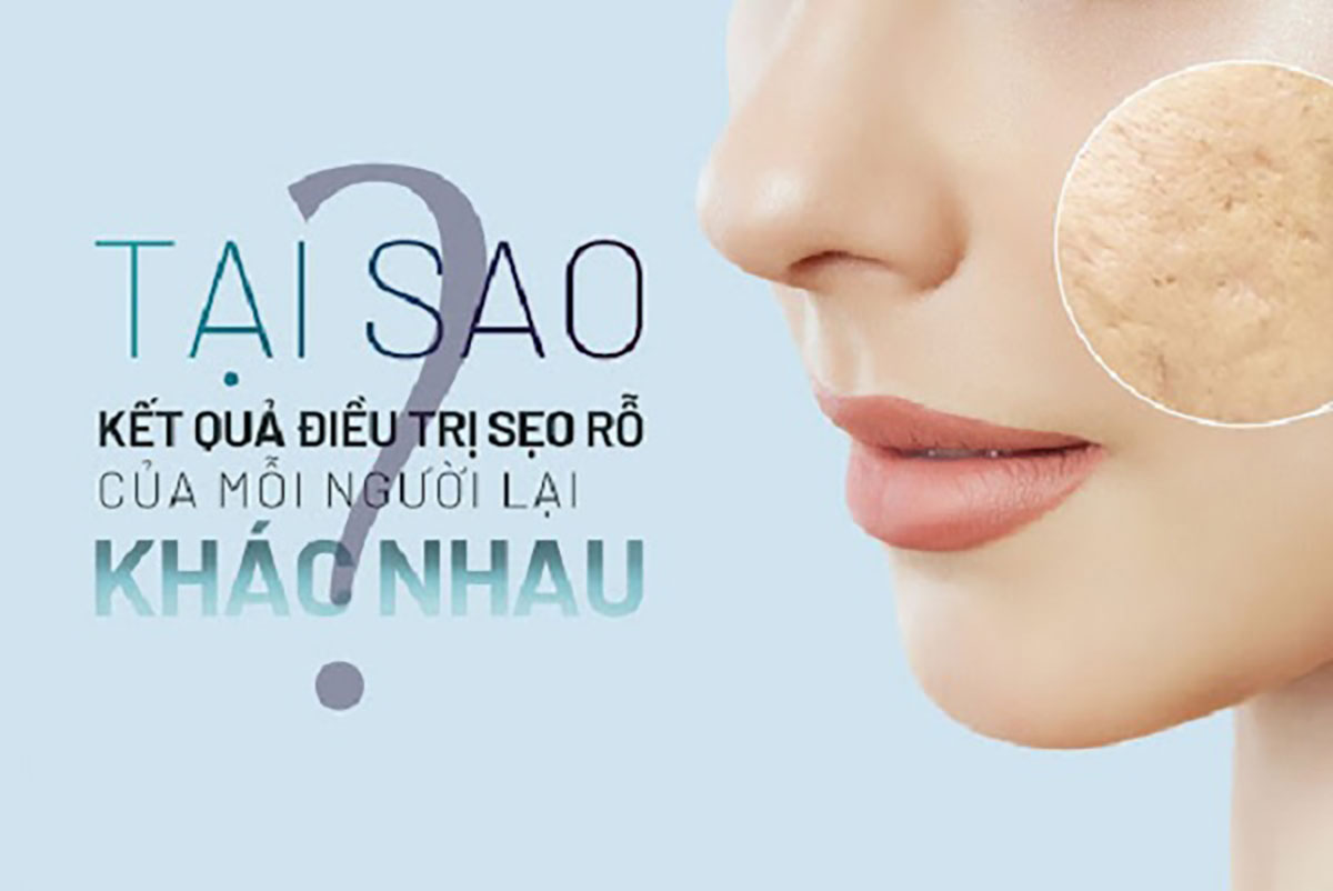 Nguyên nhân bị rỗ và cách trị rỗ mặt hiệu quả hiện nay