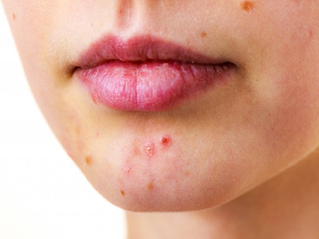 Vì sao mụn mọc quanh miệng, phải làm gì?