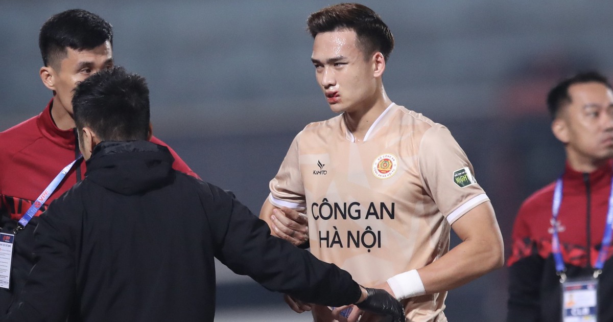 Bùi Hoàng Việt Anh rách môi, phải nhập viện khâu 24 mũi, ông Troussier ...