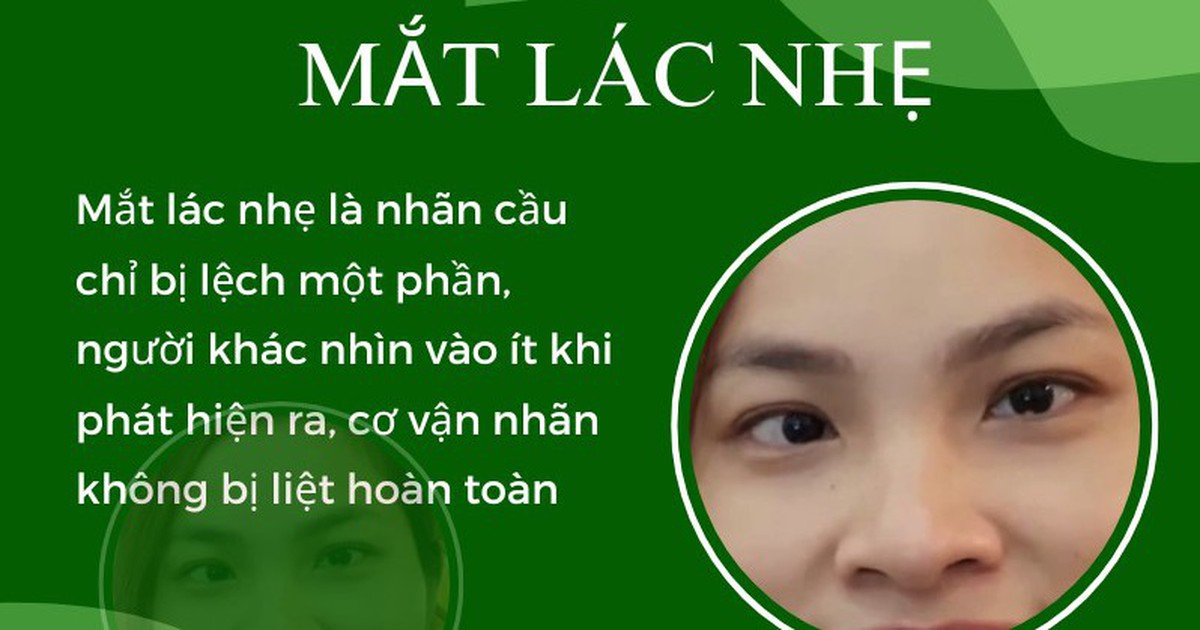 Mắt lác (lé) nhẹ: Triệu chứng, nguyên nhân, phương pháp điều trị