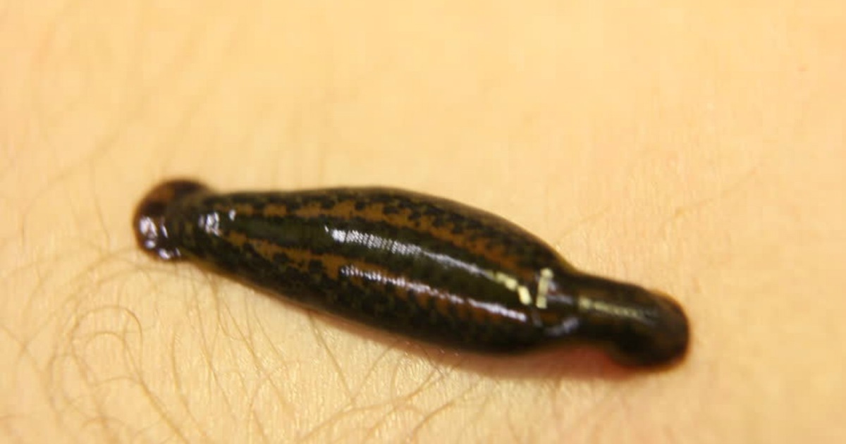 Dùng con đỉa hút máu để giảm cân ở Anh