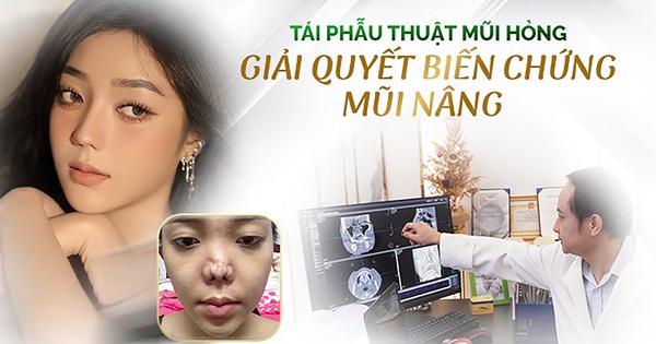 Tái phẫu thuật mũi hỏng - giải quyết biến chứng nâng mũi