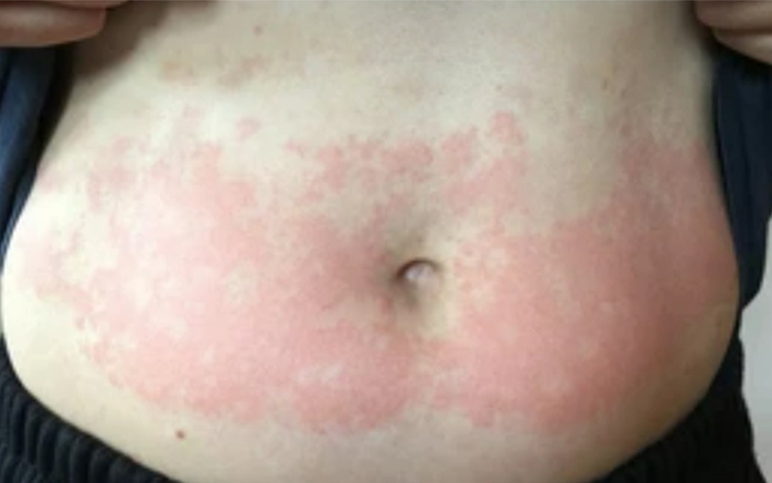 Bệnh Lupus Ban Do He Thong Hotsell | emergencydentistry.com